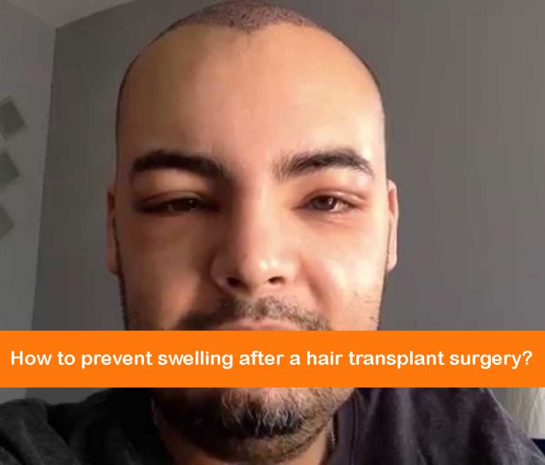 How To Prevent Swelling After A Hair Transplant Surgery Zenhair Turkiye